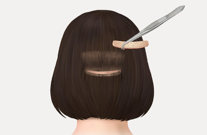 MOJELIM Hair Transplant | Female FUT Incision Hairline Correction